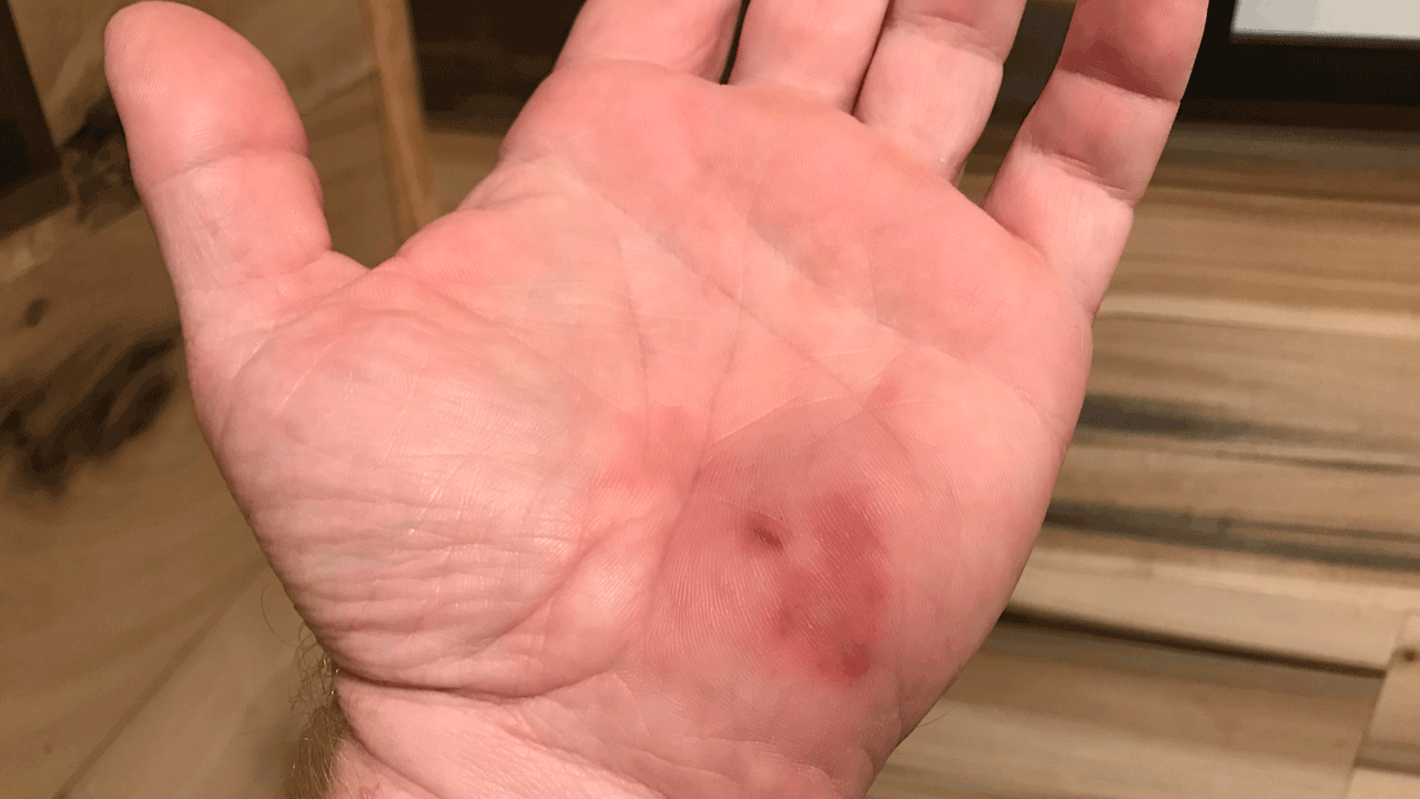 hand-infection | Bowhunting.com